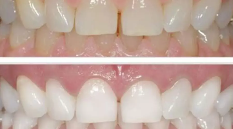 El blanqueamiento dental Hollywood Smile también es bastante fácil en casa. Mezcle agua potable y sal, aplíquelo en su cepillo de dientes y cepíllese los dientes suavemente. Puede usar este método no más de una vez a la semana, de lo contrario dañará el esmalte.