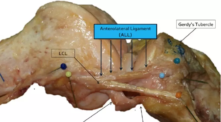 Ligamen anterolateral Cidera lutut ora dianggep salah sawijining sing paling angel: dokter asring ora ngerti sebabe dhengkul pasien dadi ora stabil. Dadi, ing wulan November 2013, ahli bedah Belgia nemokake ligamen anterolateral sing diarani, karusakan sing nyebabake akeh masalah.