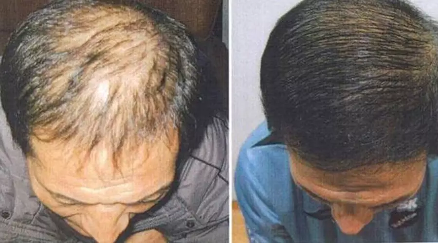 Rambut Tebal Kutukan pria berusia tiga puluhan adalah rambut rontok. Anehnya, tetapi sabun cuci juga akan membantu di sini: memperkuat akar rambut, membuatnya kuat. Ketombe, omong-omong, juga akan hilang.