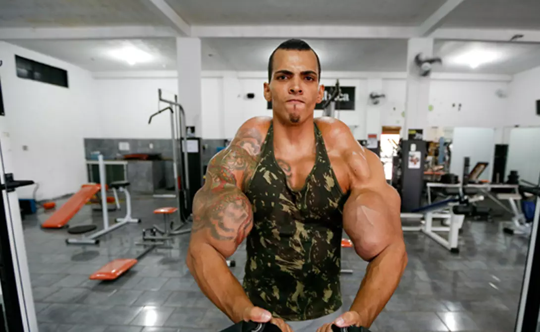 Biverkningar Synthol -pumpning har extremt negativa konsekvenser. Fettemboli i hjärnan, lunginfarkt, ischemisk stroke - och allt för att återigen tycka andra vara coolare än det verkligen är. Dessutom, efter ett tag sätter sig musklerna in, vilket inte heller tillför pseudo-idrottaren charm.