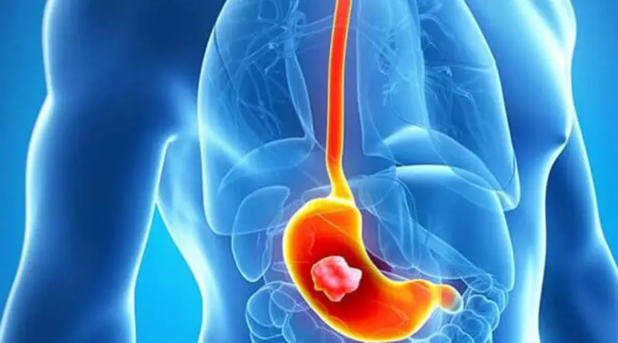 Zweer aan de horizon Zoals hierboven vermeld, zijn maagzweren meestal het gevolg van chronische gastritis. Alcohol, roken, een onevenwichtige voeding, constant slaaptekort en stress zijn de bouwstenen die je zelf aan de basis legt van toekomstige problemen.