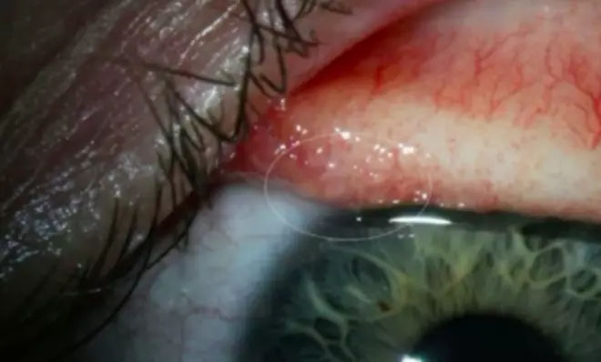 I looked at the speck and it stirred: more than a dozen parasitic worms were removed from a woman's eye