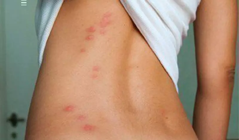 Bedbug Sometimes bedbug bites cause a very unpleasant reaction. Redness, blistering, and itching may not go away for a long time - it is worth taking anti-inflammatory drugs.