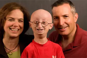 Progeria Questo è un difetto genetico molto raro, nella vita di tutti i giorni si chiama vecchiaia prematura. Un bambino può morire all'età di 13 anni - l'intero corpo ha il tempo di "logorarsi" durante questo periodo.