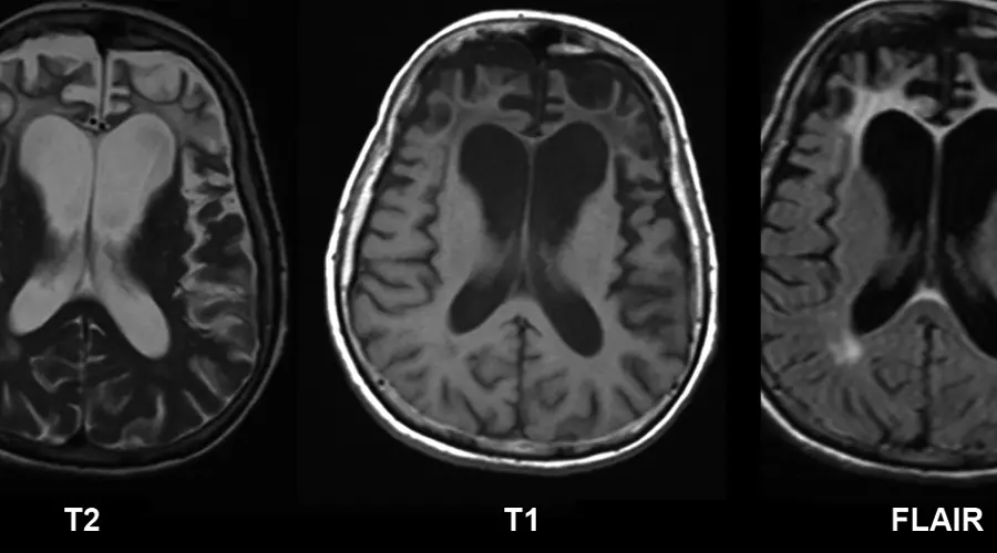 Malattia di picco Molto spesso le persone si ammalano in età adulta. I lobi temporali e frontali del cervello si atrofizzano, che porta alla demenza: una persona si perde in un flusso incessante di allucinazioni in un paio d'anni.