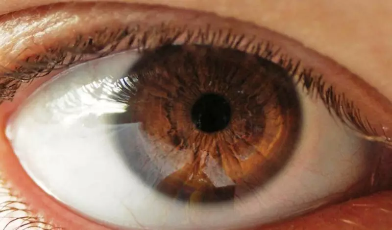 Dir kënnt Ären Cholesterolniveau selwer kontrolléieren. Eng wäiss Grenz ronderëm d'Cornea vum Auge wäert uginn datt de Problem dréngend muss adresséiert ginn.