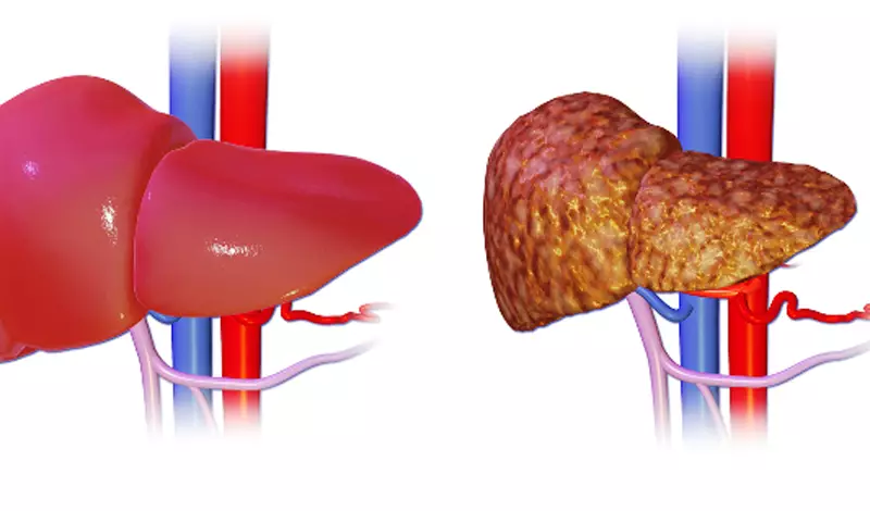 Colesterolul LDL este considerat „rău” deoarece favorizează formarea plăcii, care înfundă arterele și le face mai puțin flexibile. În schimb, HDL ajută la eliminarea colesterolului din artere în ficat, unde este distrus.