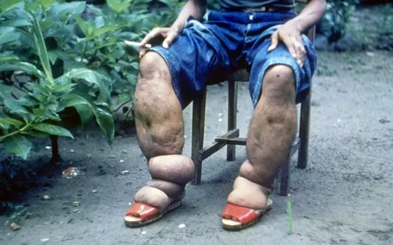 Elephantiasis Elephantiasis, Elephantiasis, Elephantiasis. Dunyodagi eng yomon infektsiyalardan biri. Bunga chivinlar olib yuradigan parazitar dumaloq qurtlar sabab bo'ladi. Voyaga etgan qurtlar tanada 7 yilgacha yashaydi, doimiy ravishda ko'payadi. JSST 2020 yilgacha limfatik filariazni parazitlarni qondan samarali tozalaydigan dorilar yordamida yo'q qilishni maqsad qilgan.