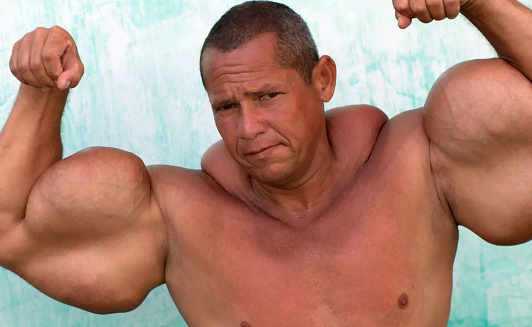 D'où vient-il Au début des années 90, le synthol a été développé par le bodybuilder (et aussi un chimiste amateur) Chris Clark. Le médicament à base d'acide gras l'a aidé, ainsi que plusieurs de ses amis, à remporter des prix lors d'événements de musculation importants - avant que le jury n'interdise complètement son utilisation.