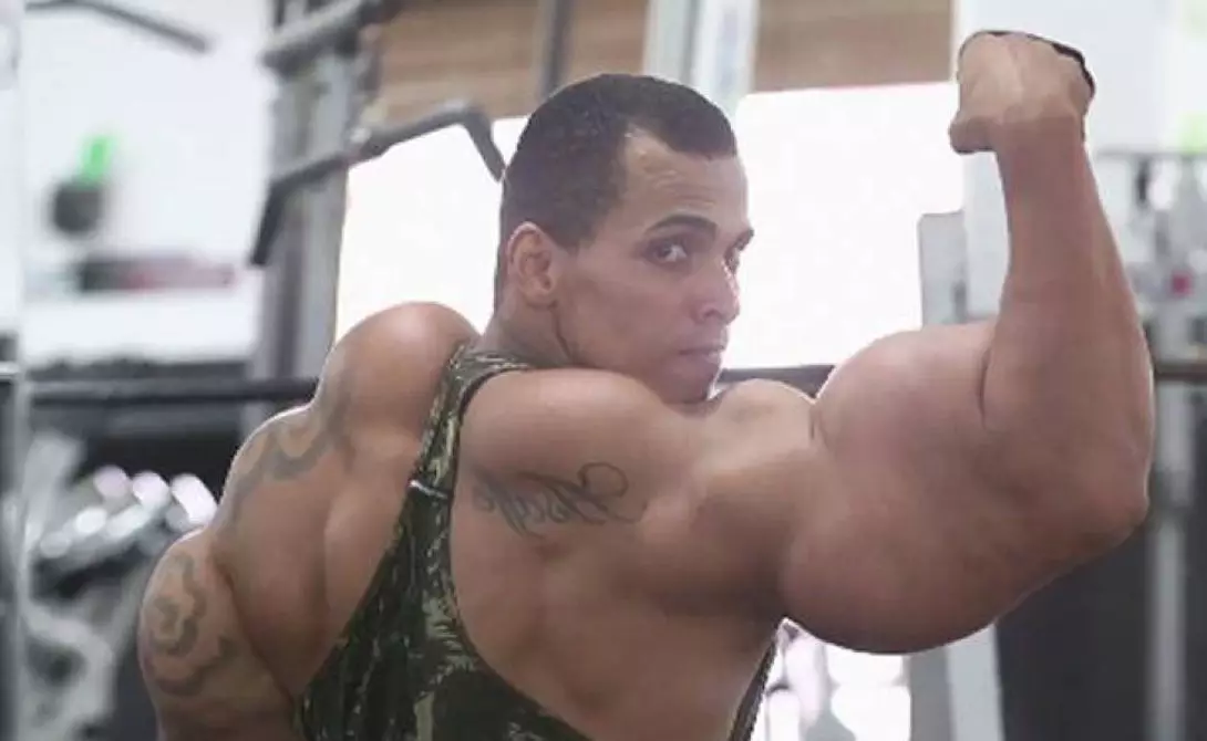 Warum injizieren sie Sportmänner, denen viele der Gefühle, die normale Menschen kennen, völlig beraubt sind, injizieren Synthol nur aus einem Grund: um das Volumen ihrer Muskeln zu erhöhen. Fett füllt den Raum zwischen den Muskelfasern aus, was zu Volumen führt. Sieht es natürlich aus? Nicht sehr.