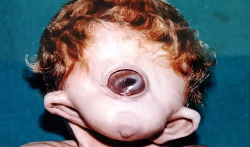 Cyclopia inowanzoitika mumhuka, asi zviitiko zvekuratidzwa muvanhu zvakaonekwawo. Iyo embryo, nekuda kwechimwe chikonzero, haina kupatsanura maziso kuita matanda maviri - muna 2006 mwana akadaro akazviratidza muIndia.