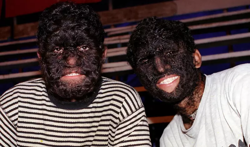 Hypertrichosis eo hangata e tsejoang ka hore ke Ambras 'syndrome kapa werewolf syndrome, hypertrichosis ke mofuta o sa tloaelehang oa lefutso o khetholloang ke moriri o mongata oa sefahleho le' mele. Mehleng e Bohareng, malimabe a joalo a ne a nkuoa e le marokho le ho chesoa, empa joale ba leka ho folisa.