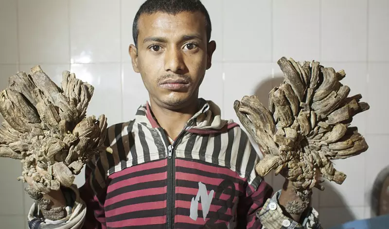 The Wooden Man Science þekkir aðeins nokkur tilfelli af warty epidermodysplasia, sem einkennist af erfðafræðilega óeðlilegri næmni fyrir papilloma hjá mönnum. Vegna þessa vaxa undarlegar myndanir, svipaðar tréspænum, um allan líkama fátæka mannsins.