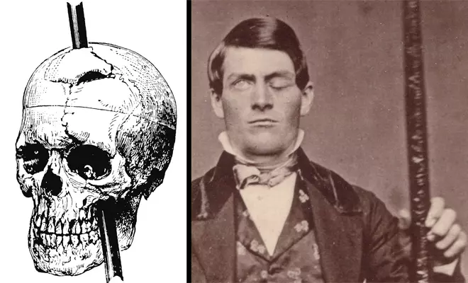 Gravi lesioni cerebrali Finneas Gage è una delle prime persone su cui i chirurghi hanno osato eseguire un'operazione neurochirurgica a tutti gli effetti. Nel 1840, Demoman Gage stava lavorando in una miniera del Vermont e aveva calcolato male il tempo di combustione. Il proiettile è esploso a 20 metri da Finneas, colpendo una barra d'acciaio con un'onda d'urto. Ha trafitto la testa dello sfortunato in tutto e per tutto. I chirurghi sono riusciti a rimuovere fino a trenta frammenti deformi dal cervello di Finneas. Sei mesi dopo, Gage tornò alla vita normale, sebbene soffrisse di frequenti mal di testa.