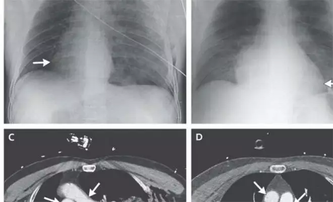 Trasformare il cuore Nel 2014, un motociclista italiano in un incidente è stato ricoverato in ospedale con sintomi insoliti. Il suo cuore iniziò a battere in modo irregolare e più lento del solito. Dopo aver esaminato l'uomo, i medici sono rimasti sorpresi nello scoprire che il cuore del ragazzo girava di 90 gradi a destra. Questa condizione è chiamata destrocardia, un difetto alla nascita, il precedente con un incidente è stato il primo. Fortunatamente, i medici sono stati in grado di invertire i cambiamenti.