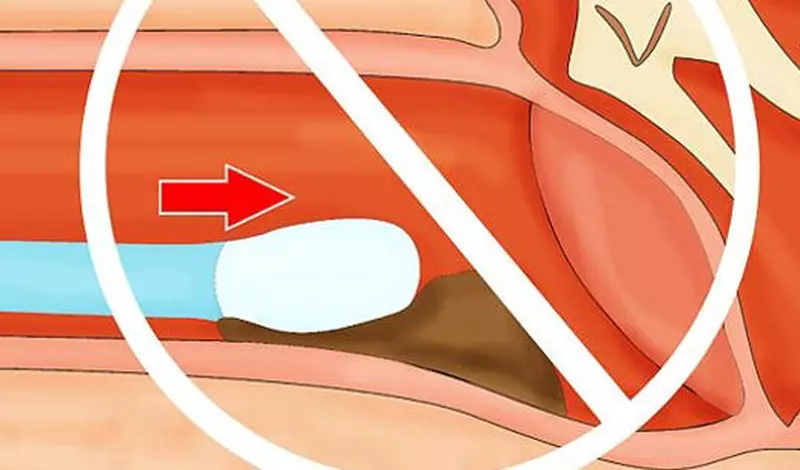 Q-tip The Q-tip should be used very carefully. Do not press on it and do not try to insert it deeper into the ear: this will not lead to anything good. It is better to forget about all kinds of hairpins, toothpicks and matches. It is very easy to damage the ear with such objects and even infect an infection, which will be very difficult to treat.