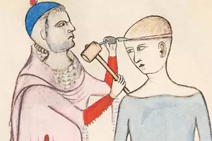 Trepanation: vad den antika Aesculapius letade efter i våra huvuden