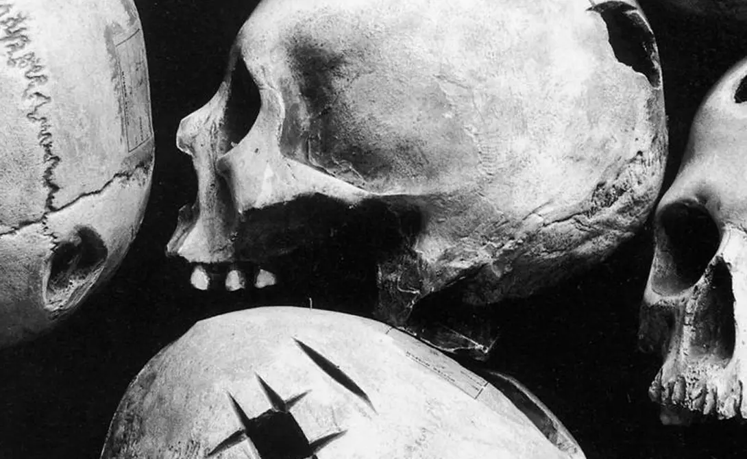 Üçüncü Göz Tibet rahipleri yüzyıllardır trepaning uygulamıştır. Kutsal prosedür zamanımızda gerçekleştirilir. Üçüncü göz için başvuran kişi özel kriterlere göre seçilir ve alnının delindiği ve deliğin tahta bir tıpa ile kapatıldığı operasyona hazırlanması uzun sürer. Birkaç gün sonra fiş çıkarılır. Bu gibi durumlarda kaçınılmaz olan enfeksiyon, başarısız vizyonerlerin yaklaşık %70'ini öldürür.