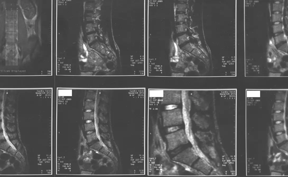 Quand un médecin est nécessaire De nombreuses personnes vivent pendant des années avec un inconfort constant dans la colonne vertébrale. En attendant, une telle attitude dédaigneuse envers le corps est lourde de problèmes de santé majeurs : mieux vaudrait jouer la prudence et se faire diagnostiquer. Si la douleur est si forte qu'elle perturbe le sommeil et ne s'atténue pas pendant plusieurs jours, vous devez absolument consulter un médecin.