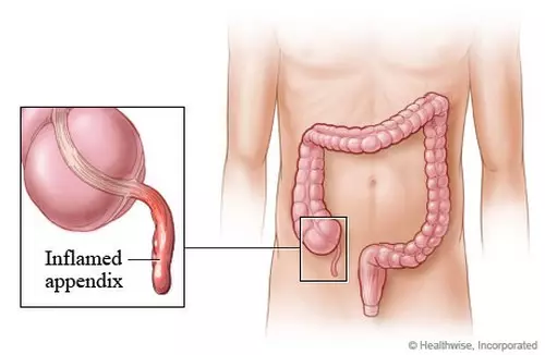 Ek İlkel insanların ağırlıklı olarak vejeteryan olduğu bir zamanda, bu organ yiyecekleri sindirmeye yardımcı oluyordu. Kalın bağırsak ve ince bağırsak arasında yer alan apendiks, büyük miktarda lifi işleme konusunda mükemmel bir iş çıkardı. Artık tamamen işe yaramaz, çok fazla soruna neden olabilir: apendiksin iltihaplanması en tatsız şeydir.